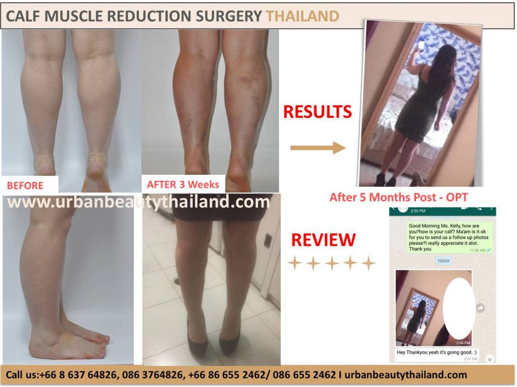 Calf Reduction Thailand - Urban Beauty Thailand