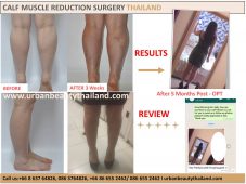 Calf Reduction Thailand - Urban Beauty Thailand