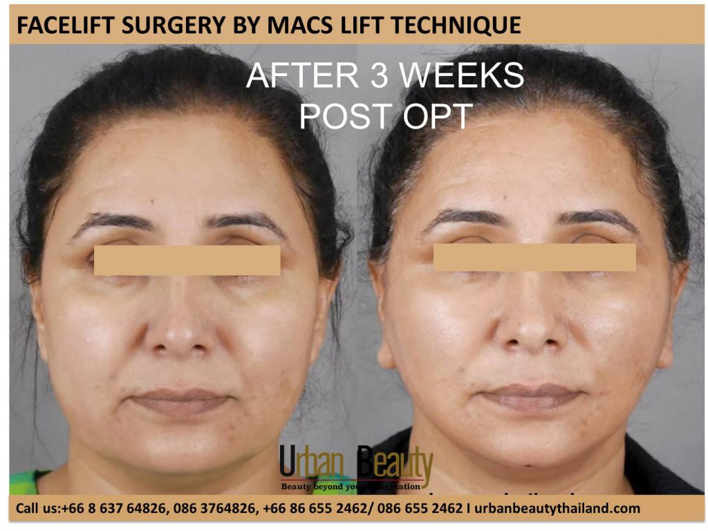 MACS-Lift Facelift Thailand - Urban Beauty Thailand