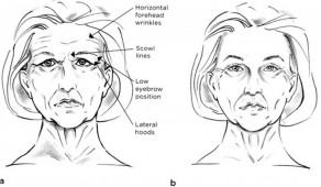 Facelift Temple Lift Thailand, Brow lift, Mid facelift Thailand