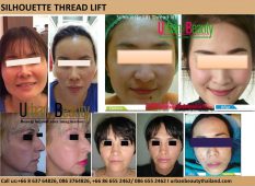 Silhouette Lift™ Thailand / Mini Facelift Bangkok - Urban Beauty Thailand