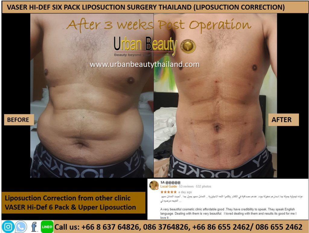 Lowest Cost From Flab to ABS VIA VASER HI-DEF in THAILAND - Urban ...