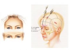 Revolutionary Endotine Ribbon Lift Facelift Thailand - Urban Beauty ...