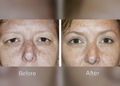 Revolutionary Endotine Ribbon Lift Facelift Thailand - Urban Beauty ...